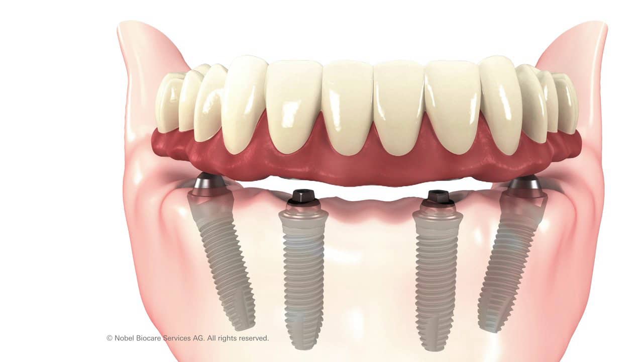 New York Dental Implants done the "MALO Clinic Way" using All-On-4 ...