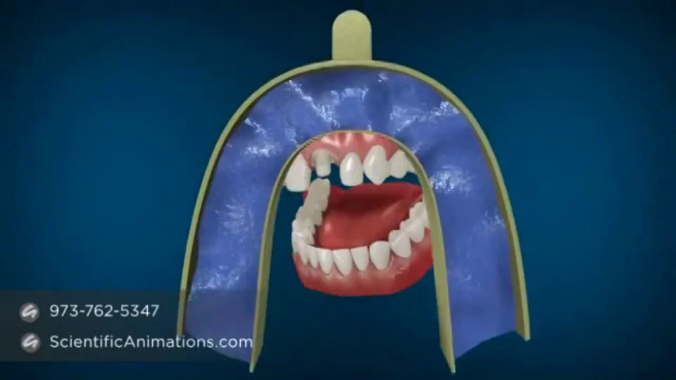 Dental Cap Procedure - Tooth Caps