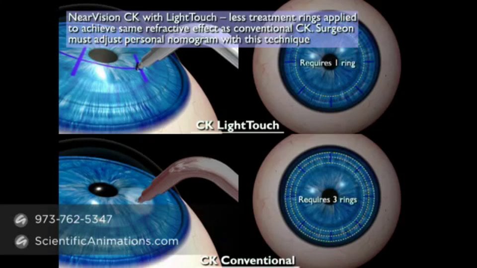 Conductive Keratoplasty Procedure - Ophthalmology Animation on Vimeo