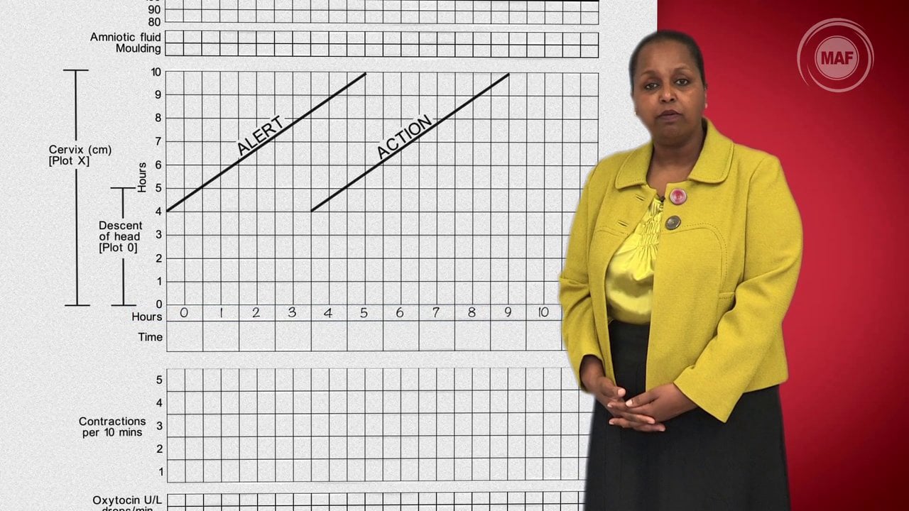 How to use a Partograph to assess women in labour on Vimeo