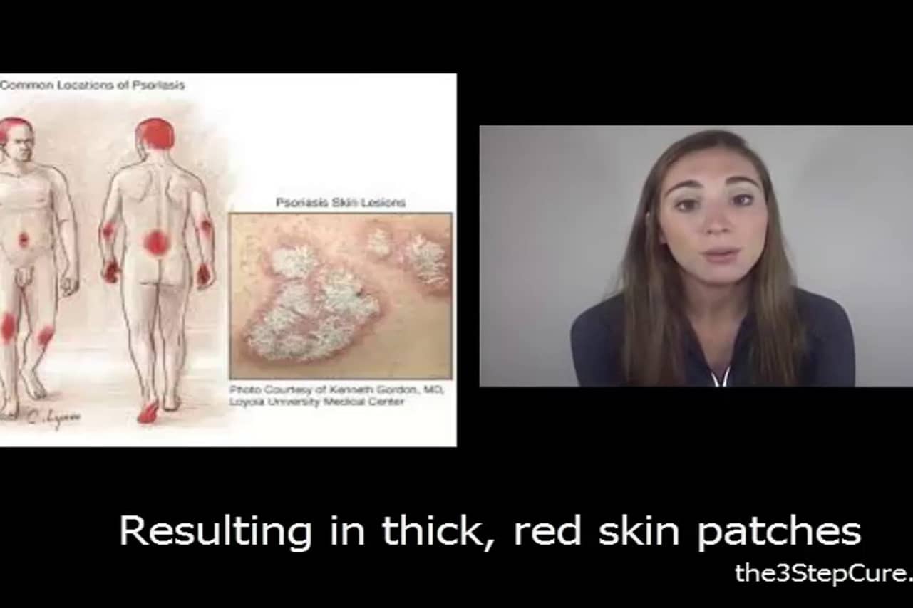 What Causes Psoriasis To Flare Up - Session 2 on Vimeo