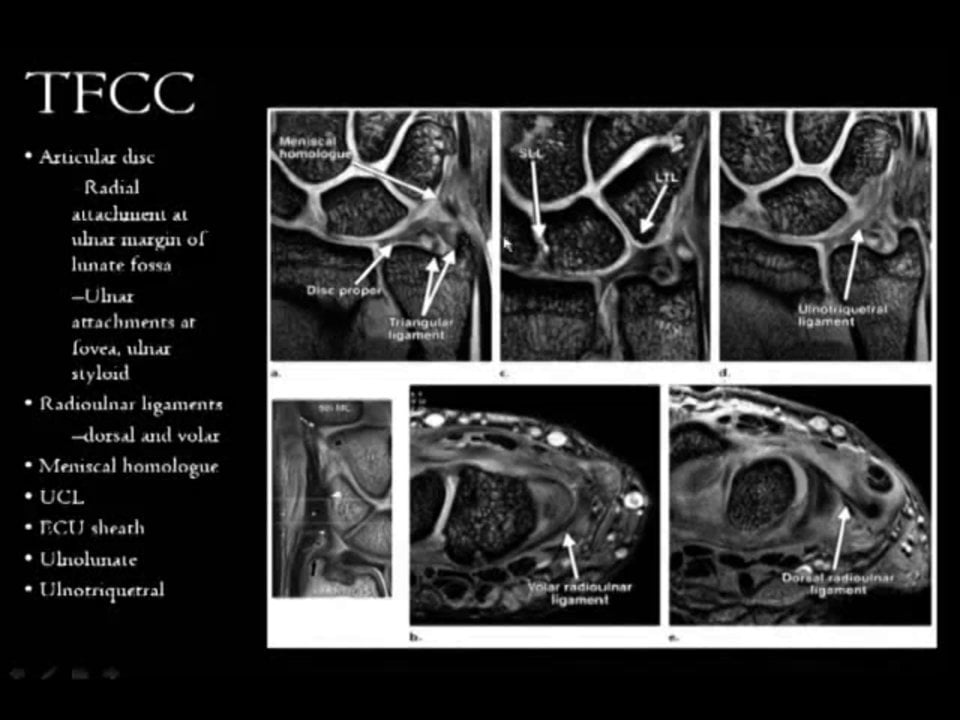 Department of Radiology - Conference Videos - Wrists Ligaments TFCC on Vimeo