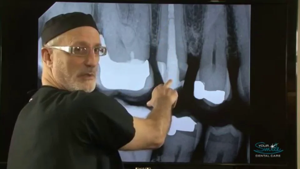 Dr. Sam Axelrod Speaks - Root Canal Treatment Procedure on Vimeo