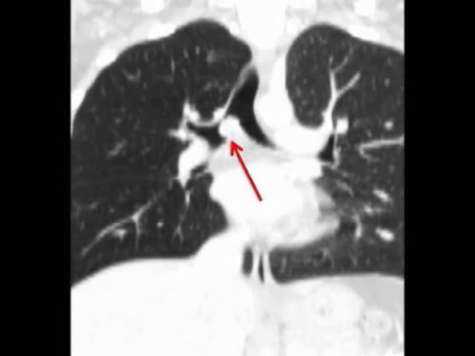 Tracheobroncoscopia rigida per resezione laser-assistita di carcinoide ...