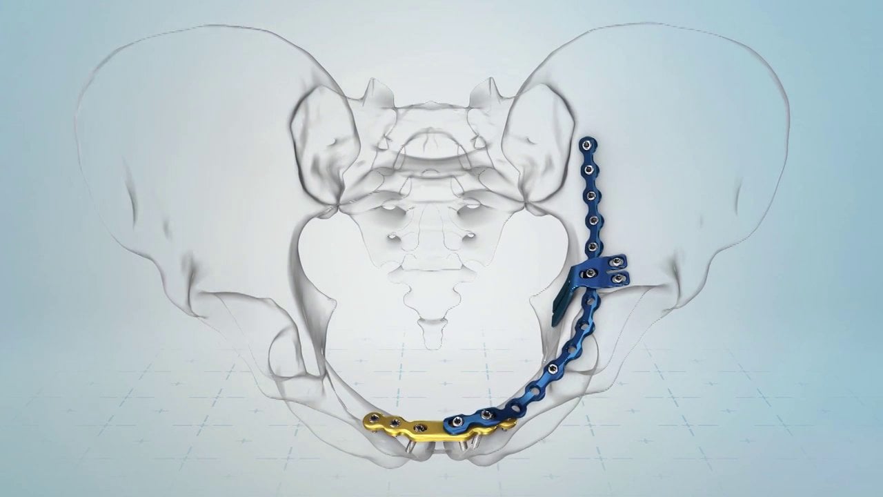 Pelvic Plating System Overview on Vimeo