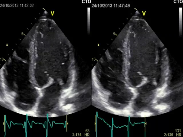 Normal Echocardiogram