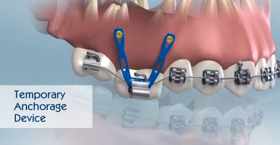 Temporary Anchorage Devices on Vimeo