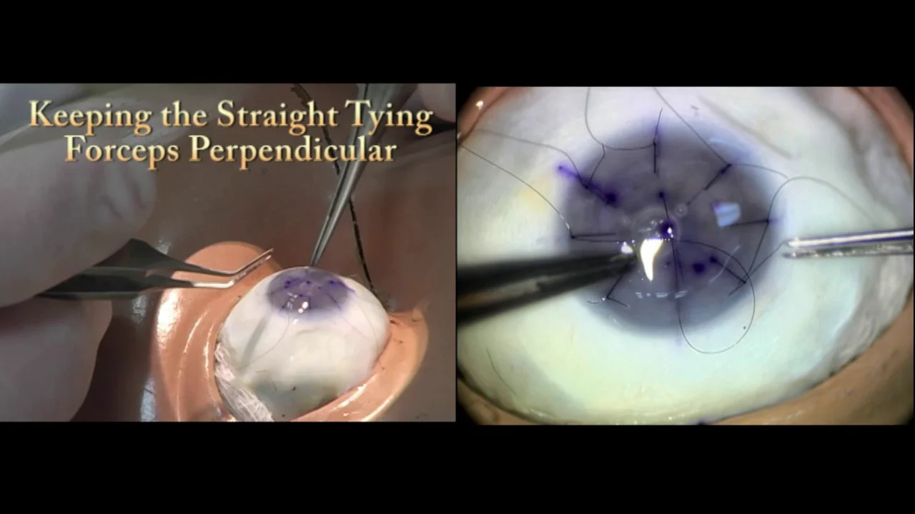 Keeping the straight tying forceps perpendicular on Vimeo