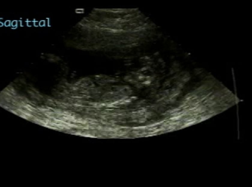 Exencephaly – ULTRASOUNDPAEDIA