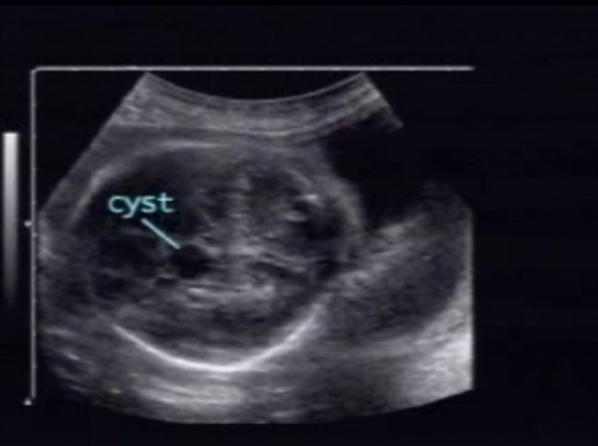 Cavum Septi Pellucidi – cyst – ULTRASOUNDPAEDIA