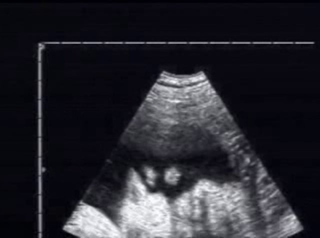 Encephalocele – frontoethmoidal – ULTRASOUNDPAEDIA