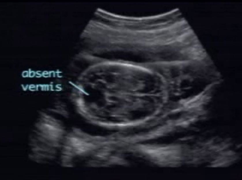 Cerebellar Vermis Ultrasound
