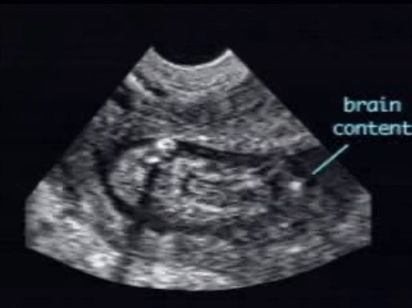 Craniorachischisis – ULTRASOUNDPAEDIA