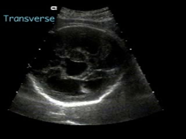 Dandy – Walker malformation – ULTRASOUNDPAEDIA
