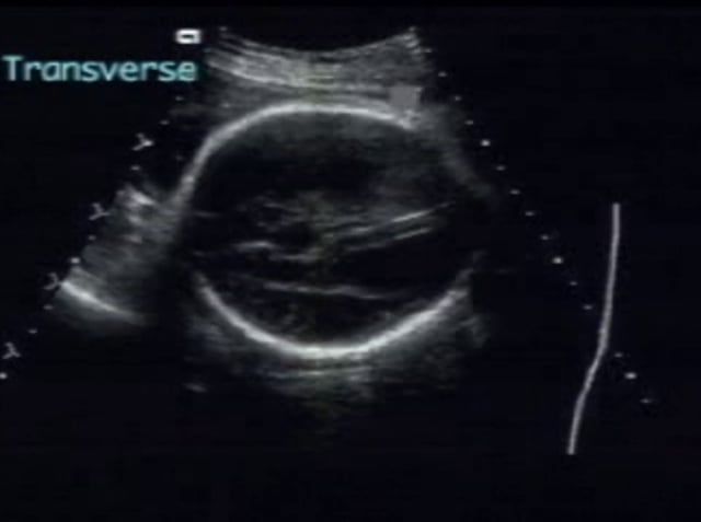 Colpocephaly – ULTRASOUNDPAEDIA