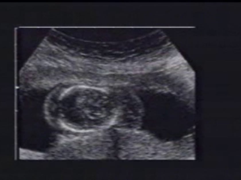 Holoprosencephaly – lobar – ULTRASOUNDPAEDIA
