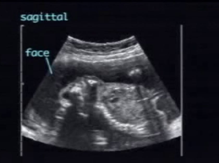 Iniencephaly – ULTRASOUNDPAEDIA