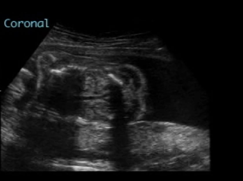 Iniencephaly – ULTRASOUNDPAEDIA