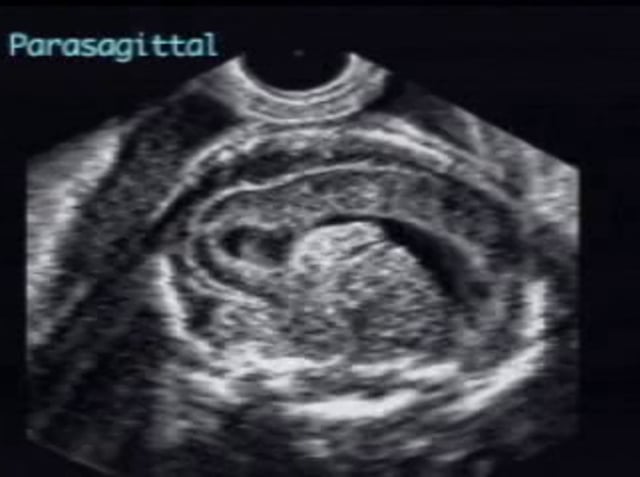 Intracranial calcification – ULTRASOUNDPAEDIA