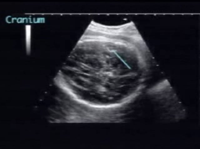 Intracranial calcification – ULTRASOUNDPAEDIA