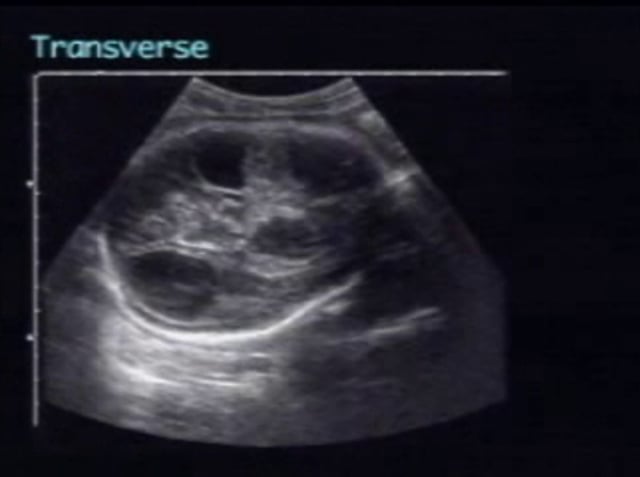 Intracranial tumors – ULTRASOUNDPAEDIA
