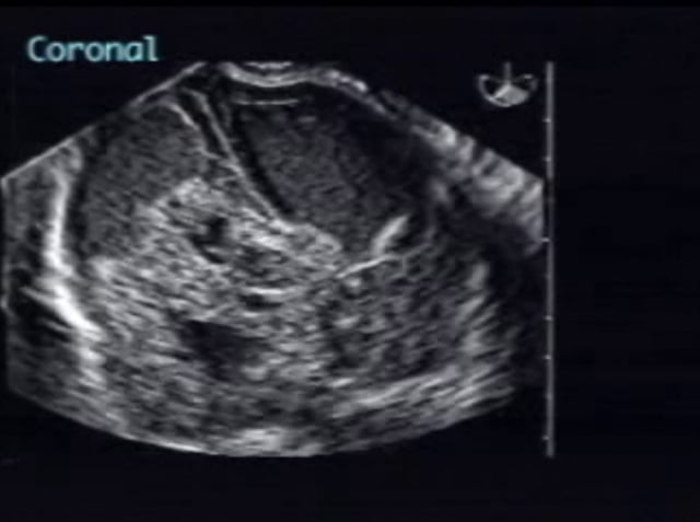 Intracranial tumors – ULTRASOUNDPAEDIA
