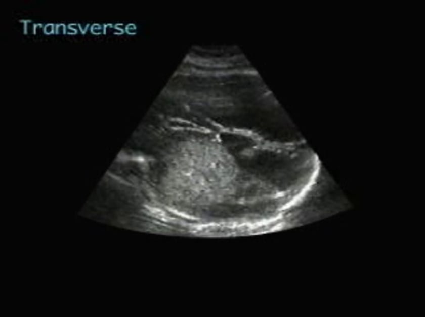 Intracranial tumors – ULTRASOUNDPAEDIA