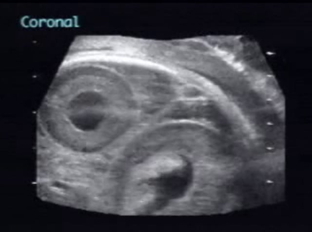 Lissencephaly – ULTRASOUNDPAEDIA