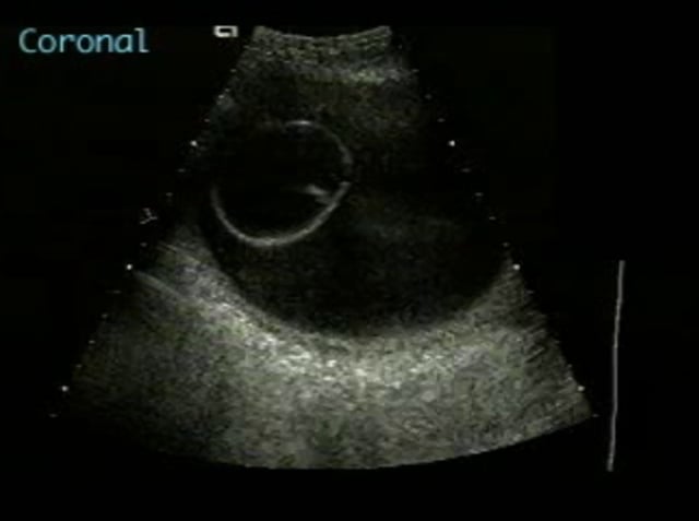 Meningocele – spinal – ULTRASOUNDPAEDIA