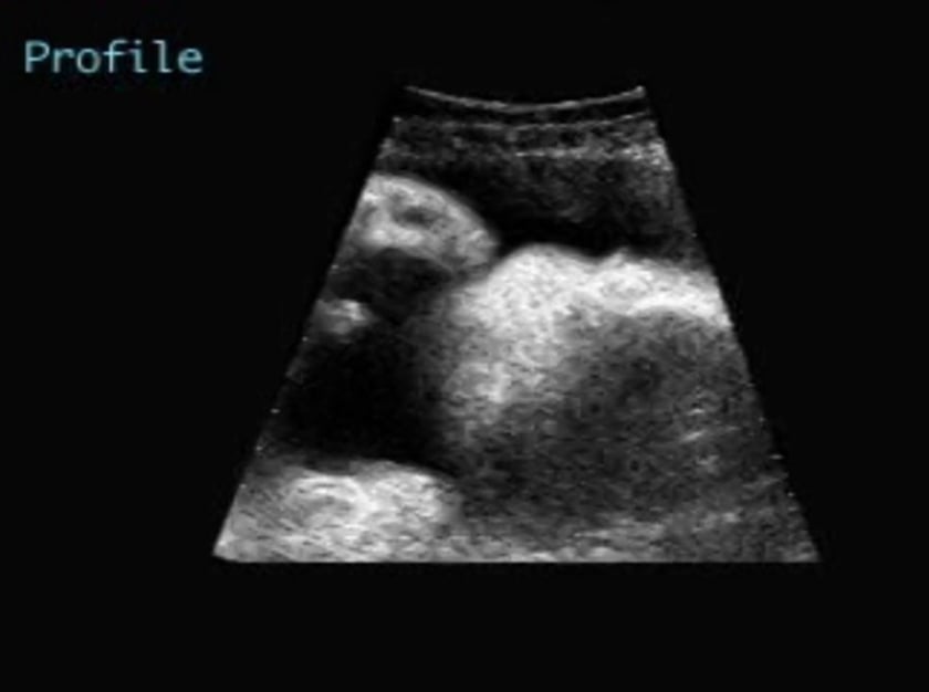 Cebocephaly – ULTRASOUNDPAEDIA