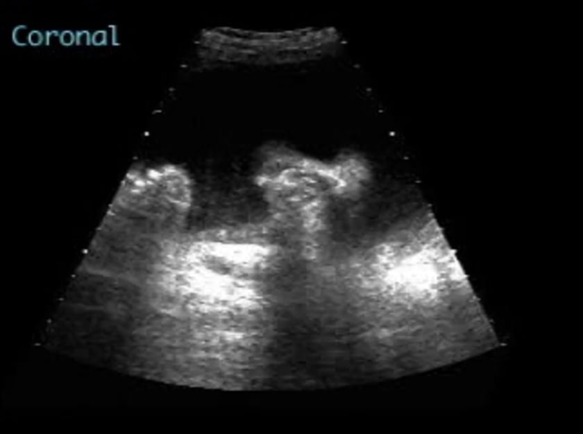 Cataract – ULTRASOUNDPAEDIA