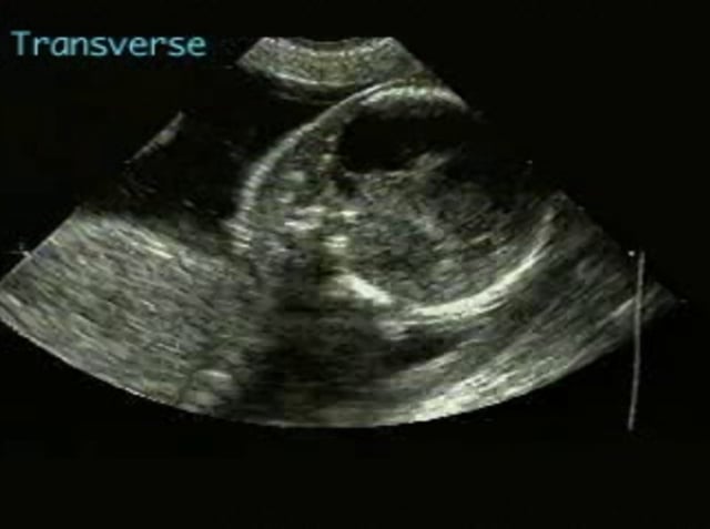Cyclopia – ULTRASOUNDPAEDIA