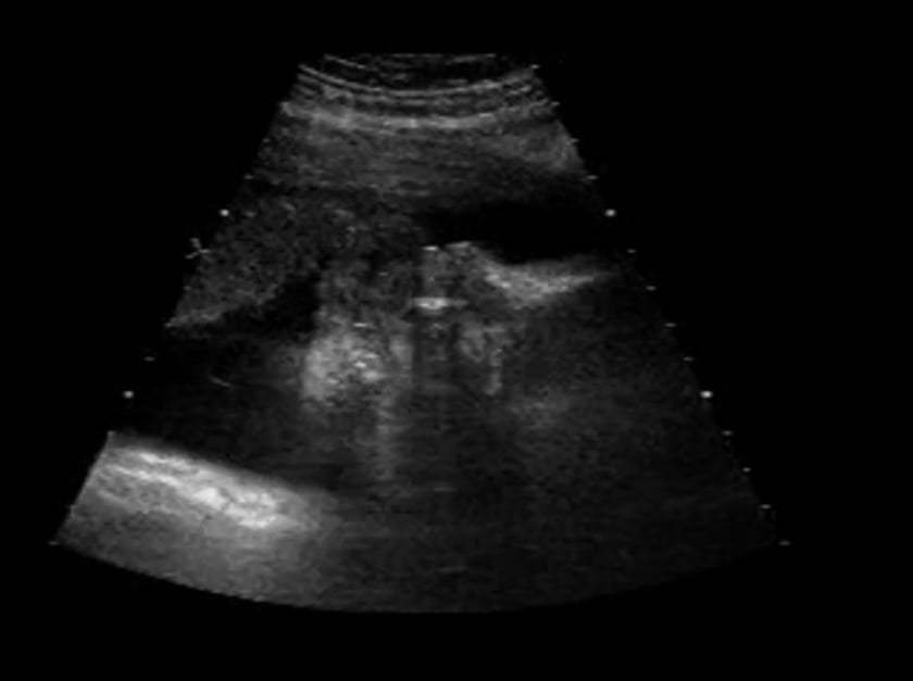 Epignathus – ULTRASOUNDPAEDIA