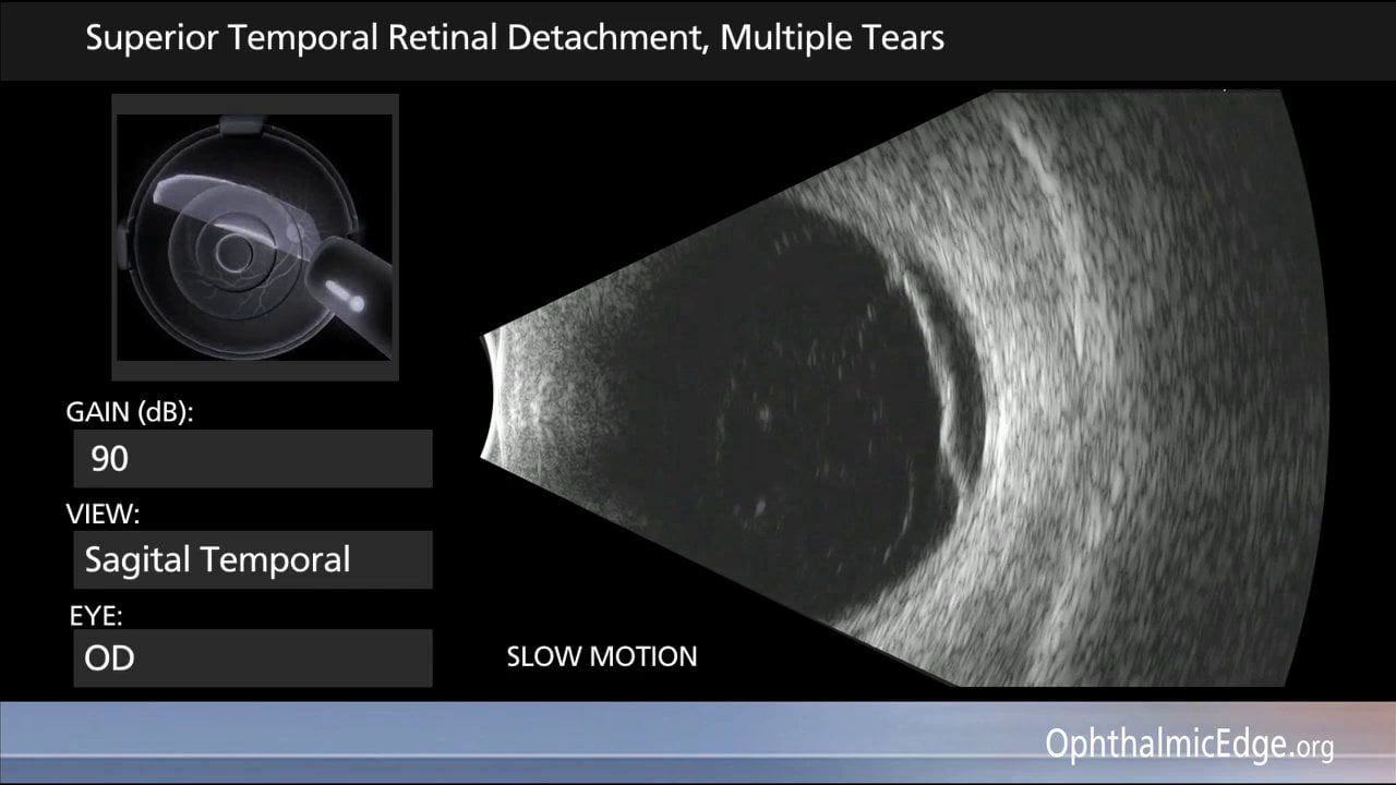 Superior Temporal Retinal Detachment, Multiple Tears on Vimeo