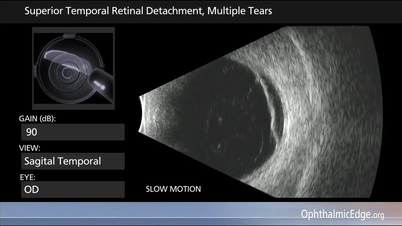 Superior Temporal Retinal Detachment, Multiple Tears