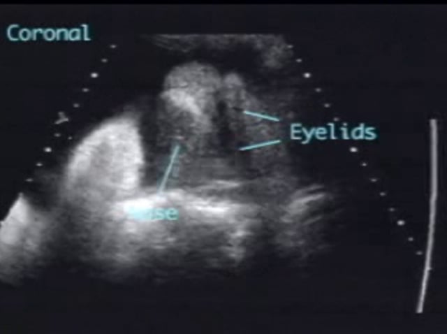 Hypotelorism – ULTRASOUNDPAEDIA