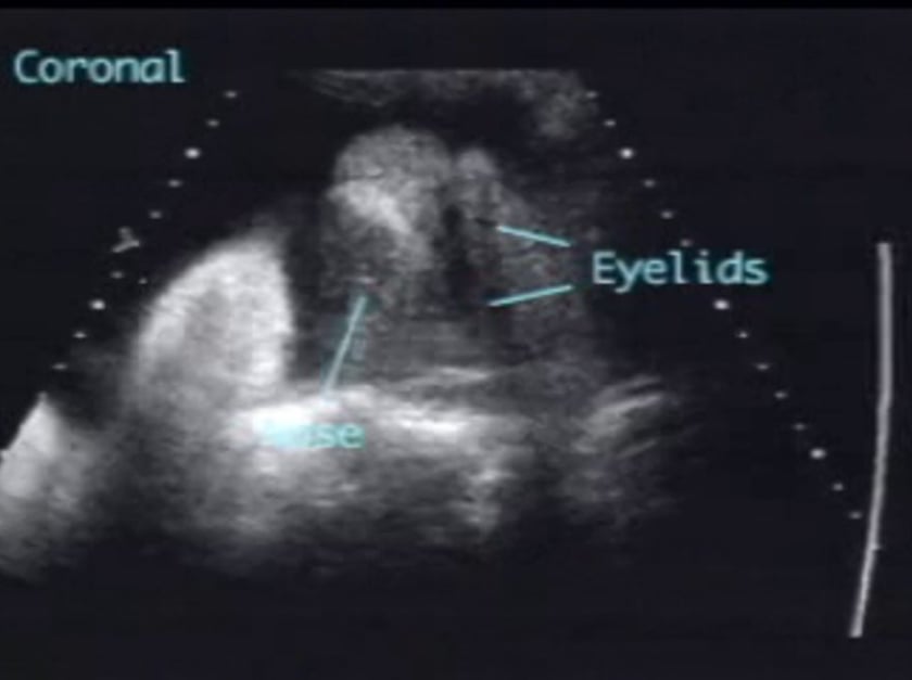 Hypotelorism – ULTRASOUNDPAEDIA