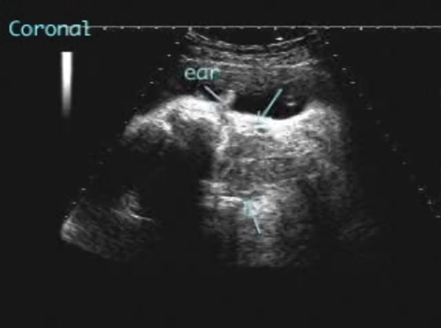 Goitre – ULTRASOUNDPAEDIA