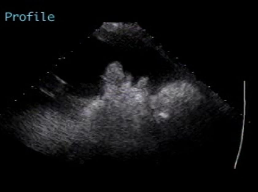 Macroglossia – ULTRASOUNDPAEDIA