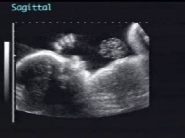 Micrognathia – ULTRASOUNDPAEDIA