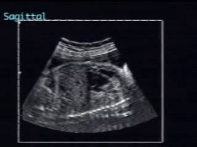 Pulmonary sequestration – ULTRASOUNDPAEDIA