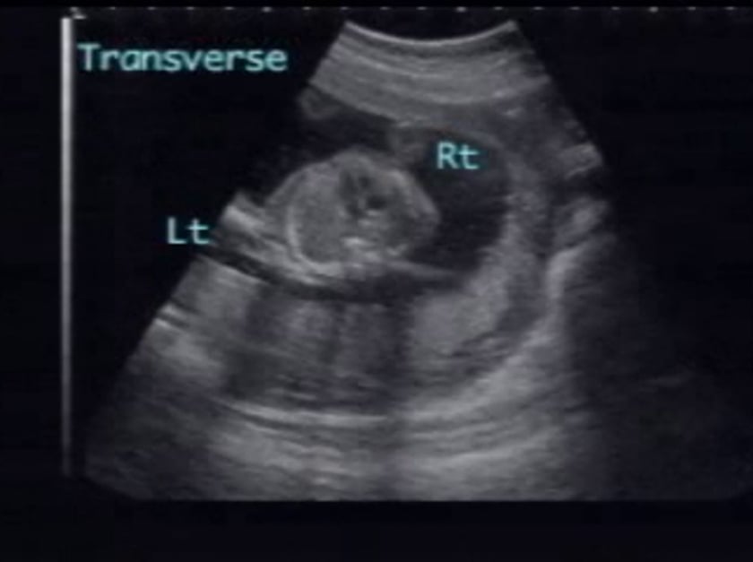 Pulmonary Agenesis – ULTRASOUNDPAEDIA