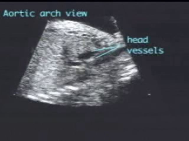 Aorta – interrupted arch – ULTRASOUNDPAEDIA