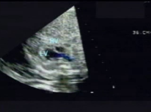 Aortic valve – incompetence – ULTRASOUNDPAEDIA