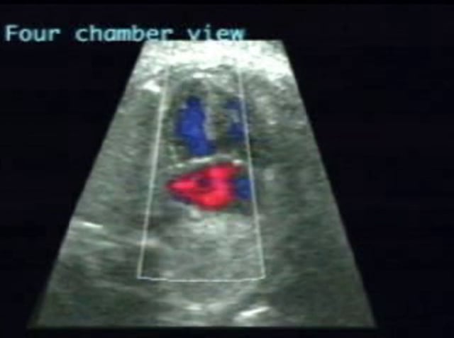 Atrioventricular septal defect (AVSD) – complete – ULTRASOUNDPAEDIA