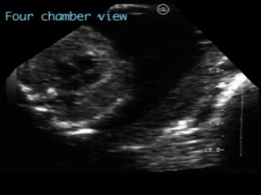 Atrioventricular septal defect (AVSD) – complete – ULTRASOUNDPAEDIA