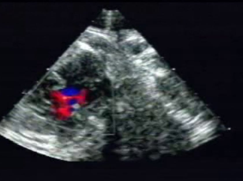 Common arterial trunk – ULTRASOUNDPAEDIA