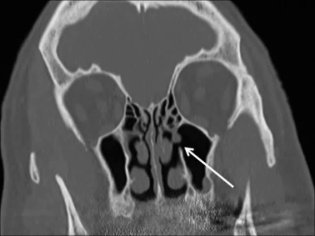 Coronal CT Scan Showing An Accessory Maxillary Sinus Ostium At The ...