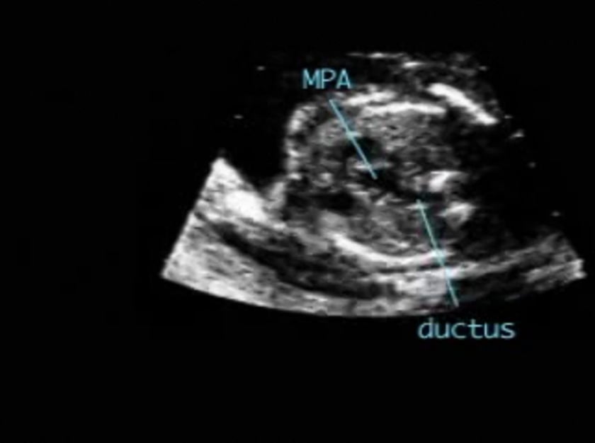 Discordant atrioventricular (AV) connection with discordant VA ...