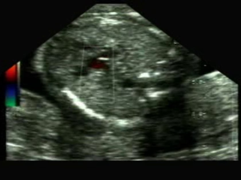 Discordant atrioventricular (AV) connection with absent Left connection ...